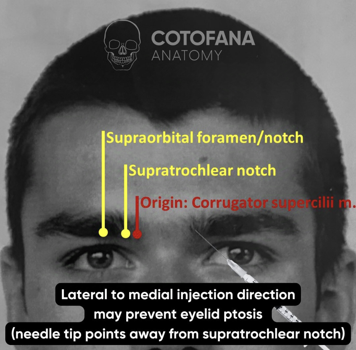 Upper Eyelid Ptosis During Neuromodulator Injections. An Exploratory ...